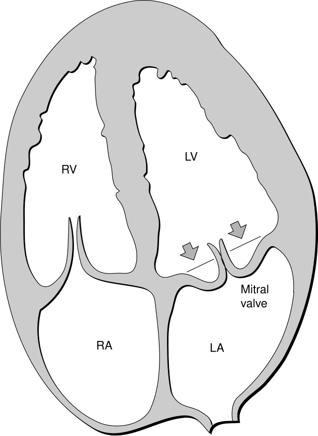 Mitral Valve Prolapse: Symptoms and Surgery - Prof. Doktor Yavuz Beşoğul